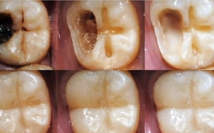 How To Naturally Repair A Cavity. Keep These Tips In Mind To Avoid ...